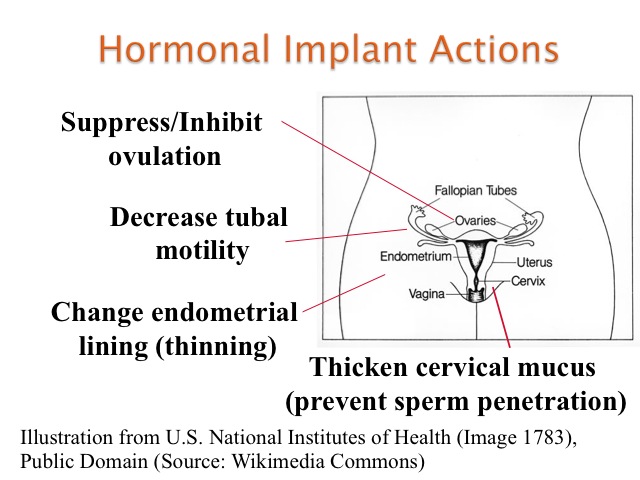 Contraceptive Implant Procedure St Paul Hospital Millennium Medical